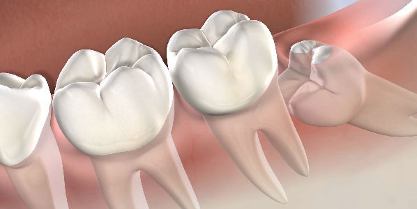 Verstandskies verwijderen | Tandheelkundig Centrum Zuiderburen
